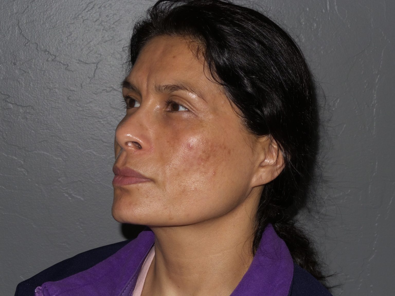 Cosmelan Peel for Hyperpigmentation: Skin Care Tucson | Skin Appeal ...