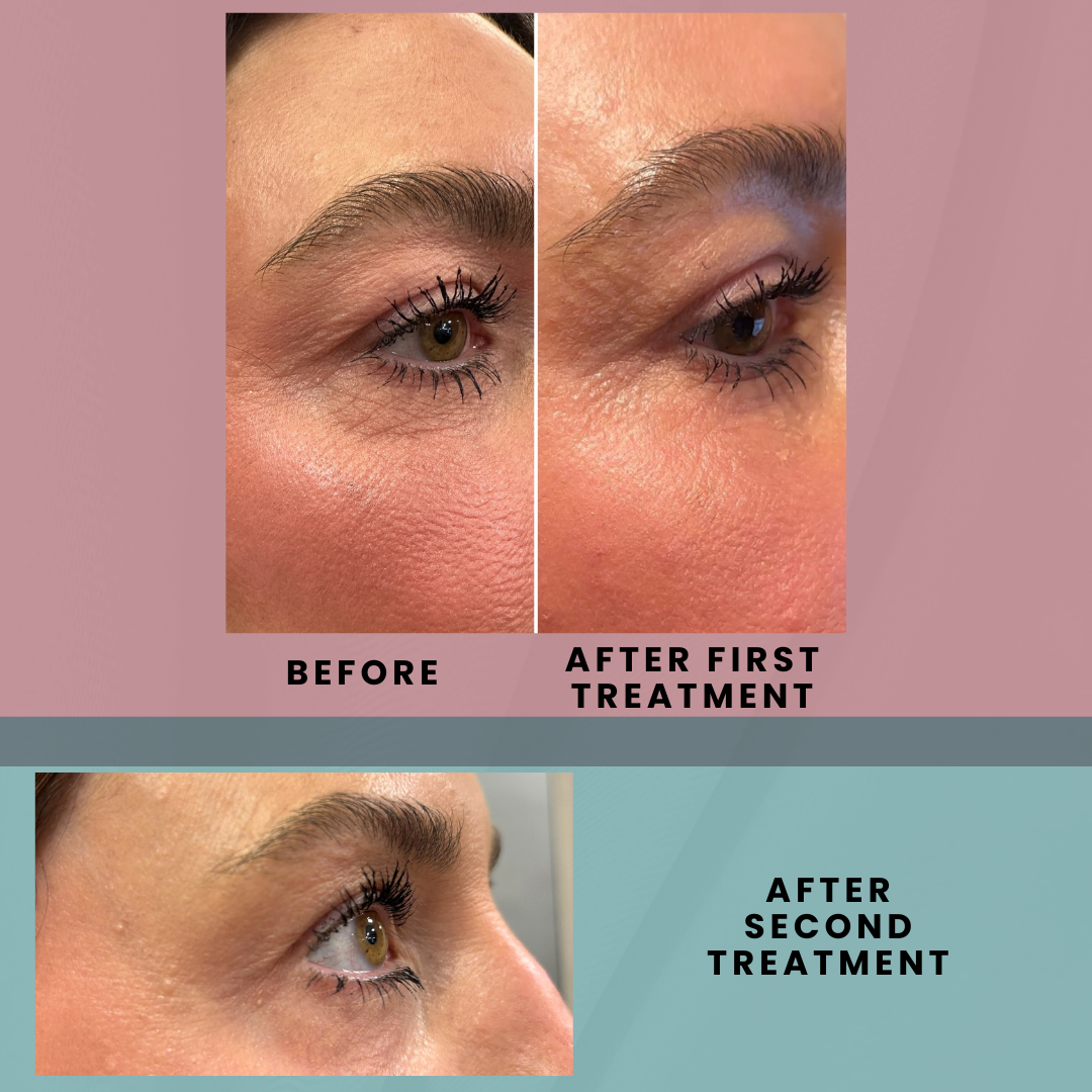 NeoGen Plasma Resurfacing: Skin Care Tucson | Skin Appeal Aesthetics ...